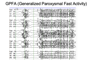 What is Lennox-Gastaut Syndrome? - LGS Foundation