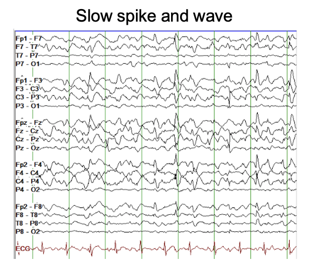What is Lennox-Gastaut Syndrome? - LGS Foundation